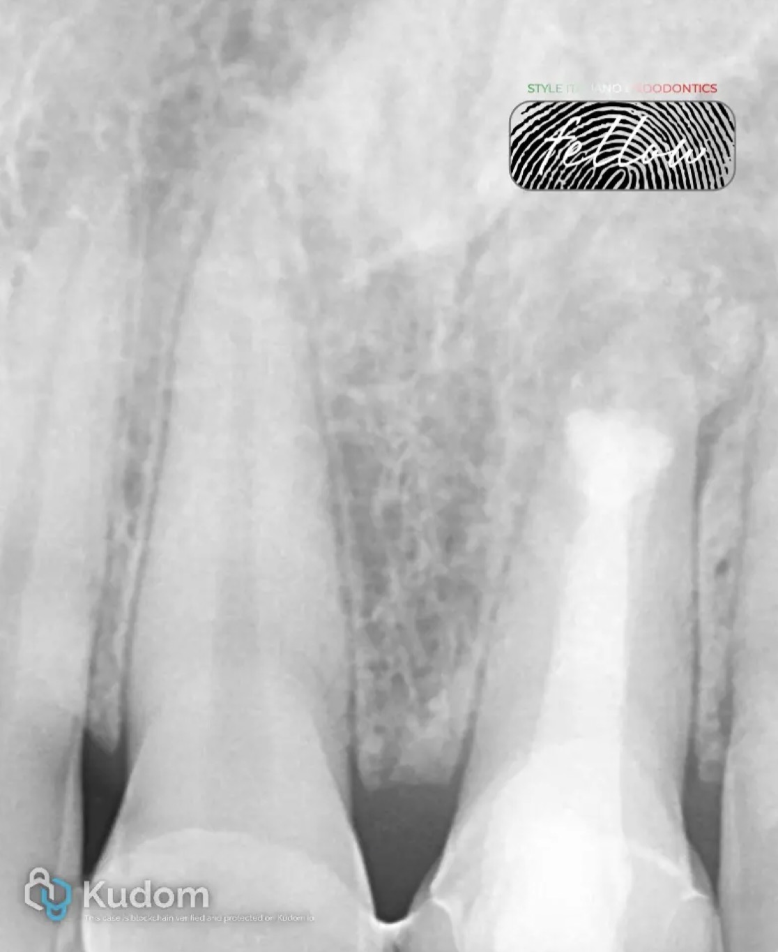 Endodontic retreatment with MTA Apexification in a maxillary central incisor with inflammatory ...